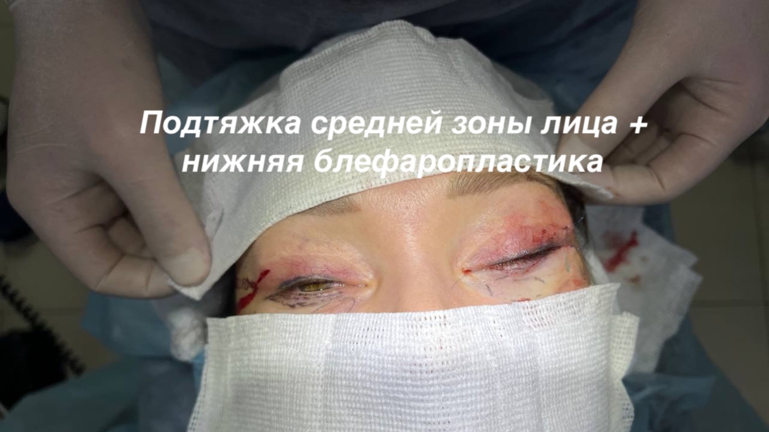 Блефаропласт + подтяжка средней зоны лица