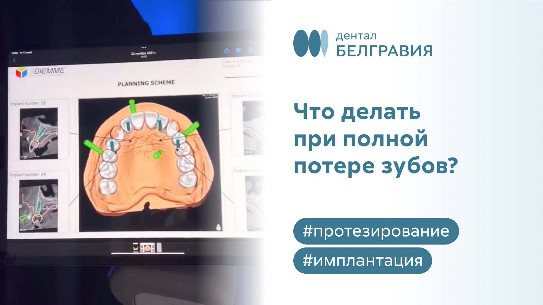 Что делать при полной потере зубов? Решение от команды врачей Belgravia Dental Studio