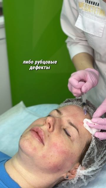 Плазмолифтинг при постакне