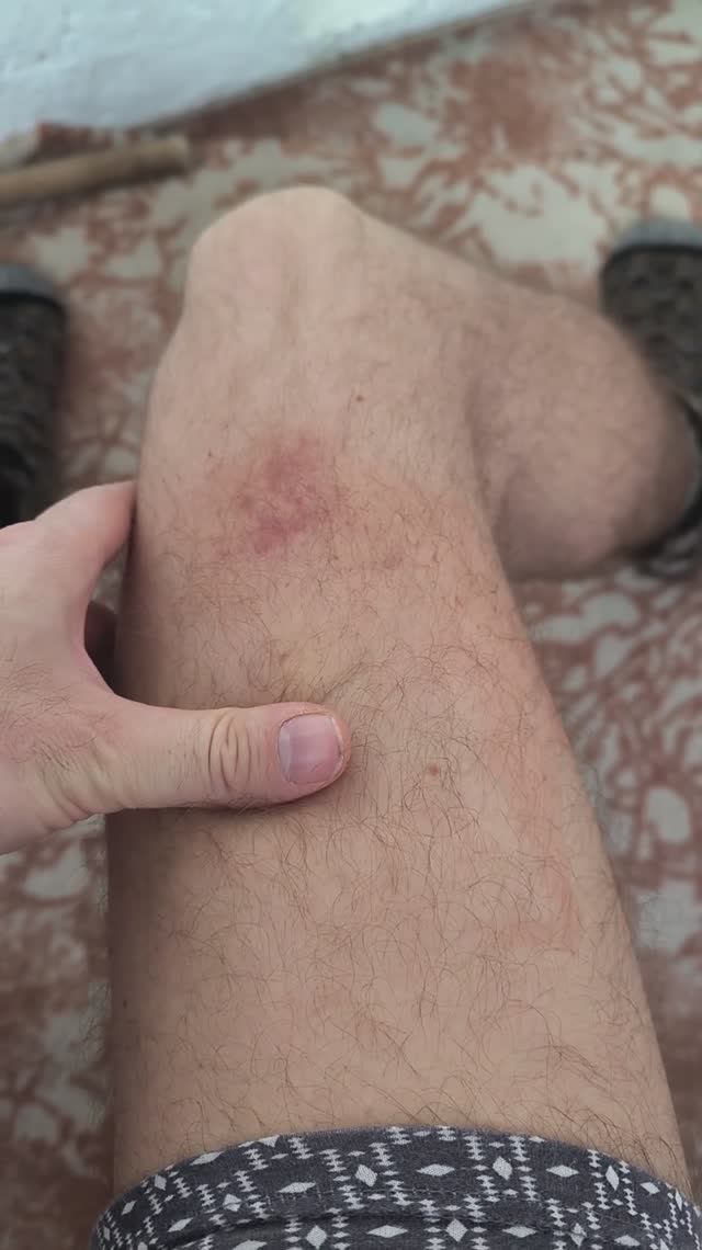 Химический ожог кожи от йода