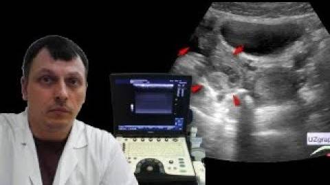 Детское ургентное УЗИ малого таза - Изменения правого яичника
