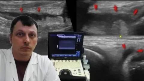 Детское УЗИ коленных суставов - Синовит коленного сустава