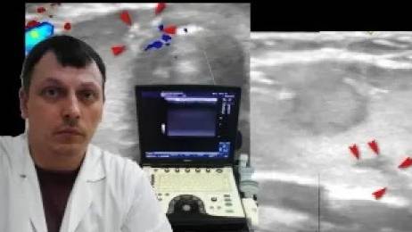 Детское УЗИ щитовидной железы - Тирадс 5 многоузловой