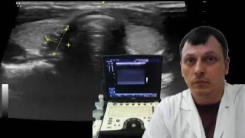УЗИ щитовидной железы - Педиатрический Тирадс 5