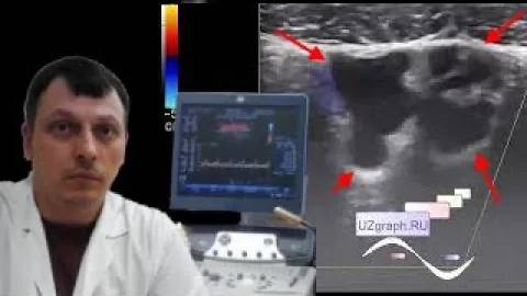 Детское УЗИ брюшной полости - Образование в гипогастрии