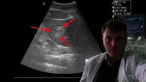 УЗИ брюшной полости - Гемангиома печени