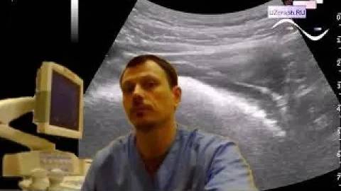 Детское УЗИ кишечника - Болезнь Гиршпрунга на УЗИ