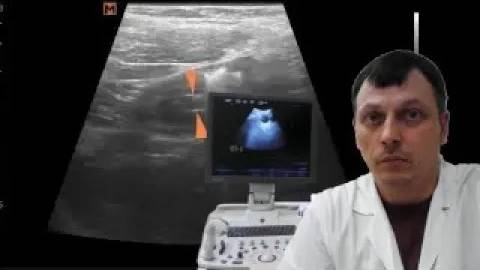 Детское УЗИ брюшной полости -  Недолеченный аскаридоз