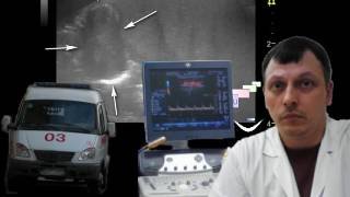 Детское УЗИ брюшной полости - Кишечный инфильтрат на УЗИ