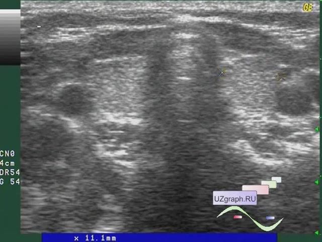 Лекция: УЗИ щитовидной железы. Базовый уровень