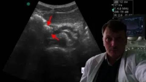 УЗИ брюшной полости - Образование головки поджелудочной железы