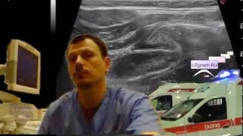 Детское УЗИ брюшной полости -  Ретроперитонеальный аппендицит на УЗИ