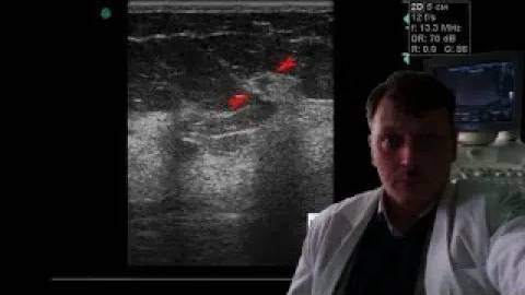 УЗИ молочных желез - Образование по типу звезды