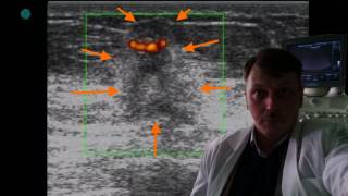 УЗИ молочных желез - Birads 5 (рак молочной железы на УЗИ)