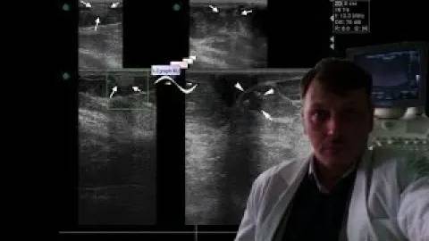 УЗИ молочных желез - Гемангиоматоз молочных желез и birads 4-5