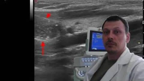 Детское УЗИ щитовидной железы - Добавочная/ аберрантная доля вилочковой железы/ тимуса