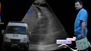 Детское УЗИ легких - Ателектаз легкого ...