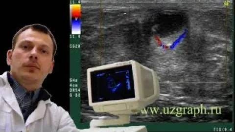 Детское УЗИ молочных желез - Киста с воспалением (подострый мастит)