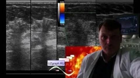 УЗИ молочных желез - Birads 4-5