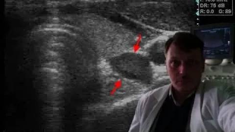 УЗИ паращитовидных желез - Гиперпаратиреоз