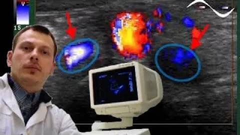 Детское УЗИ сосудов (УЗДГ) - Удвоение нижней полой вены