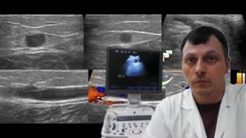 Детское УЗИ сосудов (УЗДГ) - Варикозная болезнь вен нижних конечностей