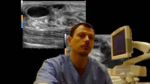 Детское УЗИ молочных желез - Кисты молочных желез