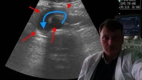 УЗИ сосудов (УЗДГ) - Аномалия каудальной аорты