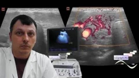 Детское УЗИ щитовидной железы - Диффузные изменения ЩЖ