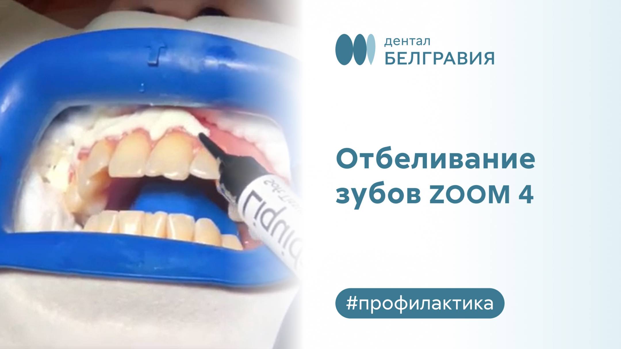 Отбеливание зубов ZOOM 4 в Belgravia Dental Studio