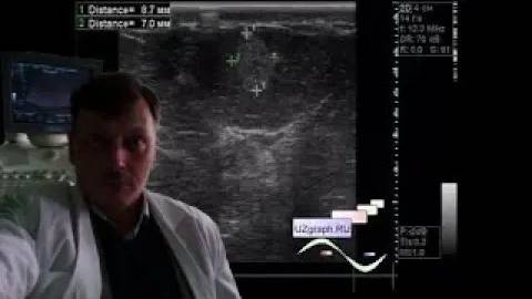 УЗИ молочных желез - Образование молочной железы