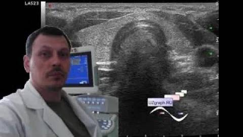 Детское УЗИ щитовидной железы - Гипоплазия левой доли ЩЖ