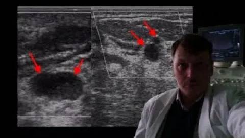 УЗИ молочных желез - Образования молочных желез