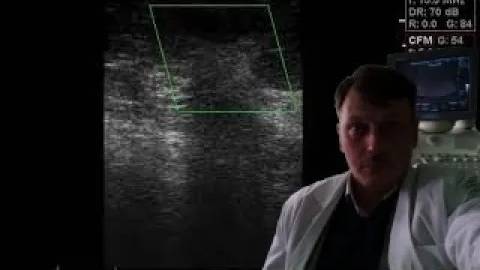 УЗИ молочных желез - Би-радс 4-5