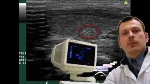 Детское УЗИ щитовидной железы - Область щитовидной железы с гиперэхогенными точечными включениями