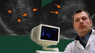 Нейросонография - Повышение перивентрикулярной эхогенности