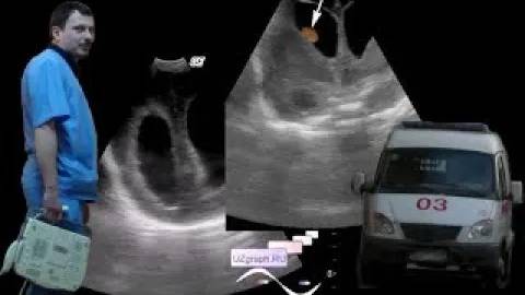 Нейросонография (УЗИ) - Гидроцефалия, внутрижелудочковое кровоизлияение