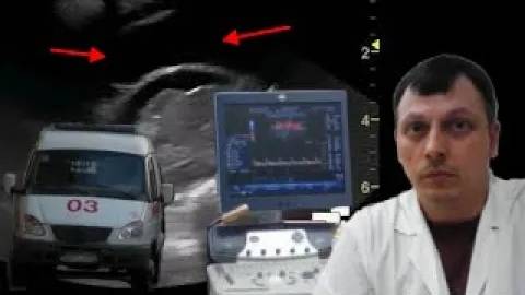 Детское УЗИ головного мозга (нейросонография) - Субтотальная энцефаломаляция