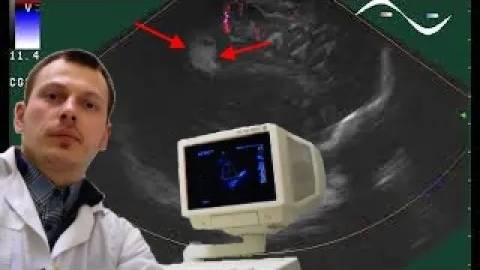 Нейросонография (УЗИ головного мозга) - Образование теменной области головного мозга