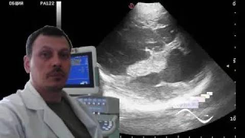 Нейросонография - Субтотальная энцефаломаляция