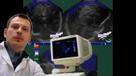 Нейросонография -  Субдуральное кровоизлияние