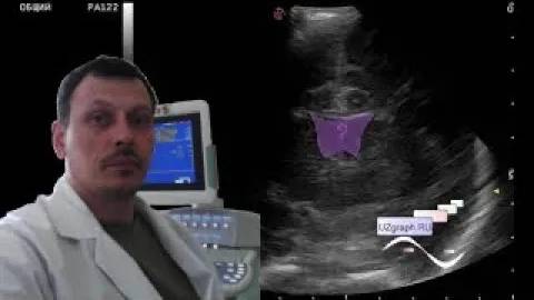 Детское УЗИ головного мозга (нейросонография) - Отсутствие (агенез) полости прозрачной перегородки