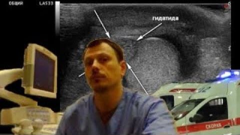 Детское УЗИ мошонки - Орхоэпидидимит на фоне перекрута гидатиды