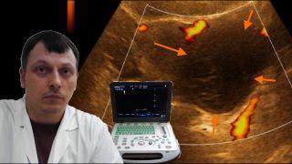 Детское УЗИ органов малого таза - Геморрагическая киста яичника