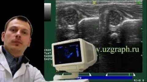 Детское УЗИ тазобедренных суставов - Подвывих тазобедренного сустава (тип III по Граф)