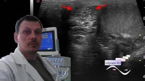 Детское УЗИ мошонки - Рецидив сперматоцеле у подростка