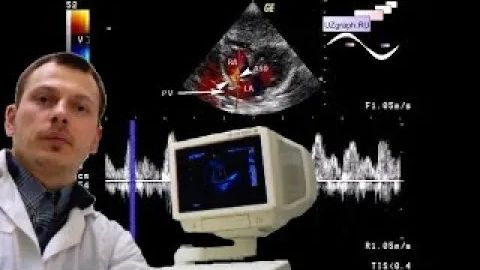 Детское УЗИ сердца (эхокардиография) - ДМПП типа sinus venosus