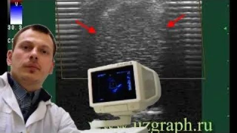 Детское УЗИ мошонки - Имплант яичка