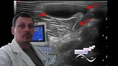 Детское УЗИ коленных суставов - Билатеральные кисты Бейкера