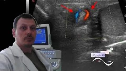 Детское УЗИ мошонки - Перекрут семенного канатика